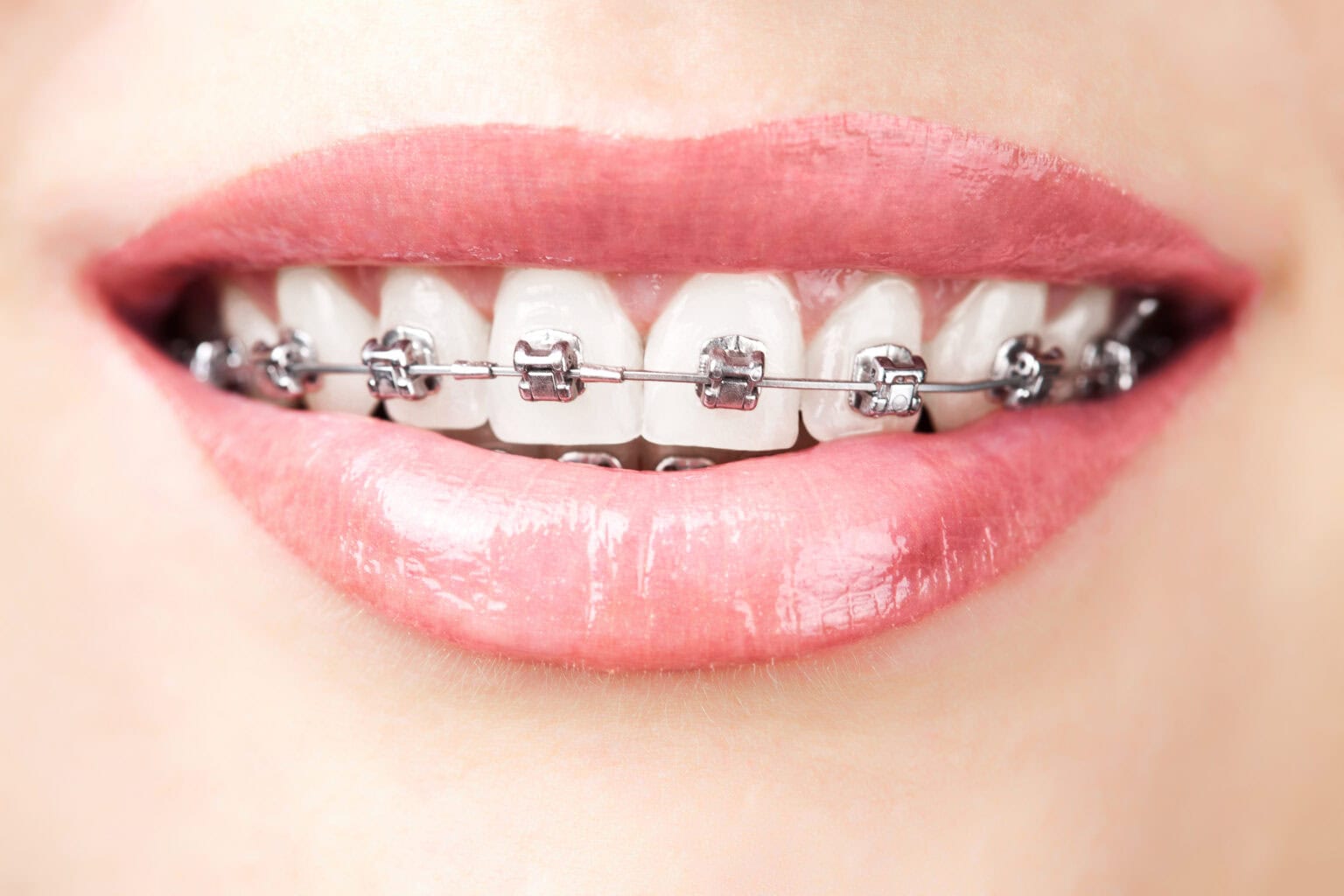 Braces in Longmont, CO - Longmont Orthodontics